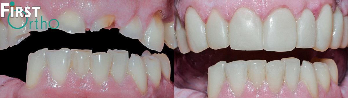 TMJ pain: tooth wear, clicking, jaw ache | First Ortho