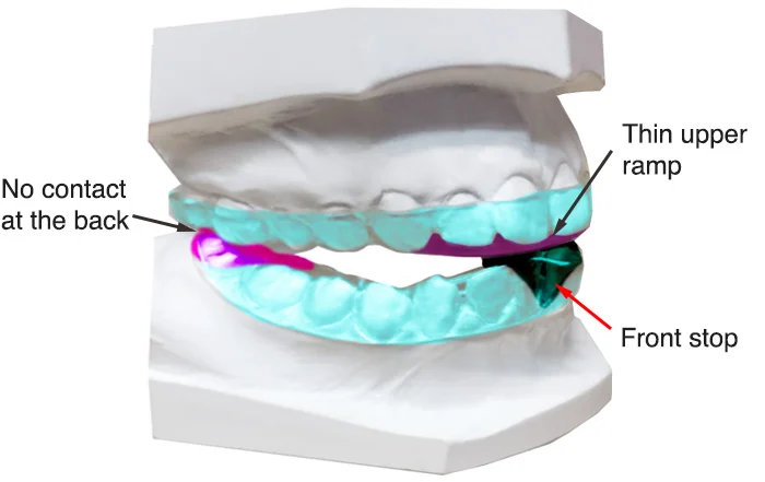 TMJ pain: tooth wear, clicking, jaw ache | First Ortho