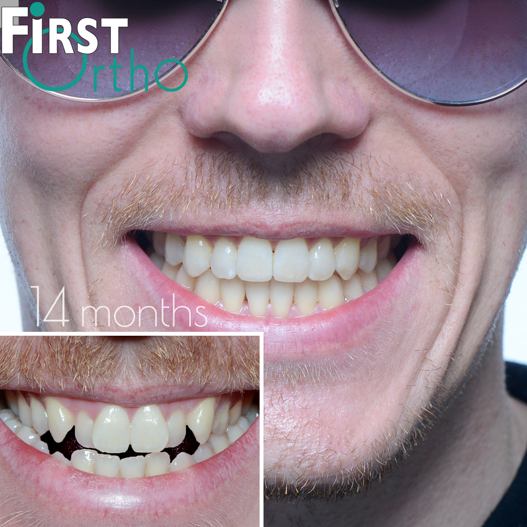 Underbite, crowding and openbite - First Ortho