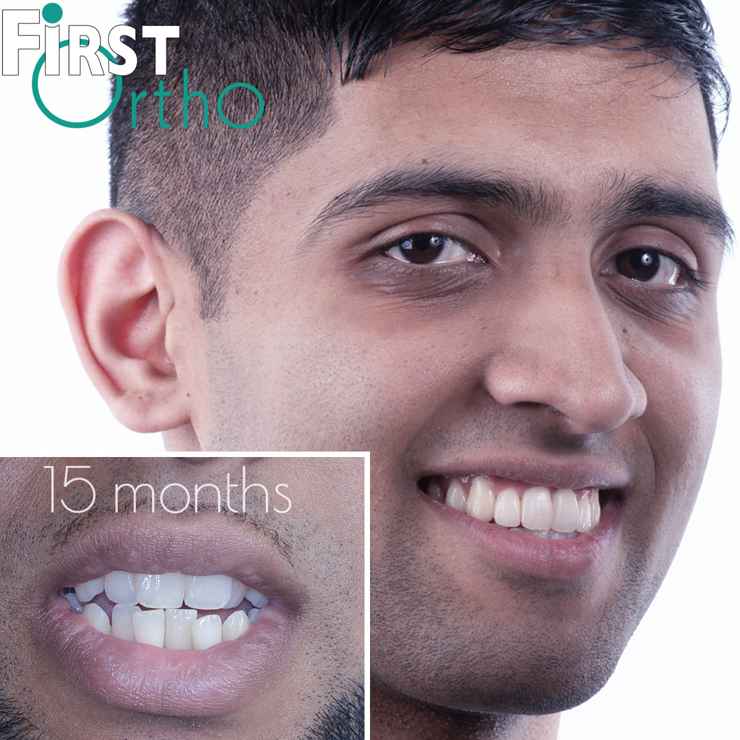 Arch expansion - First Ortho