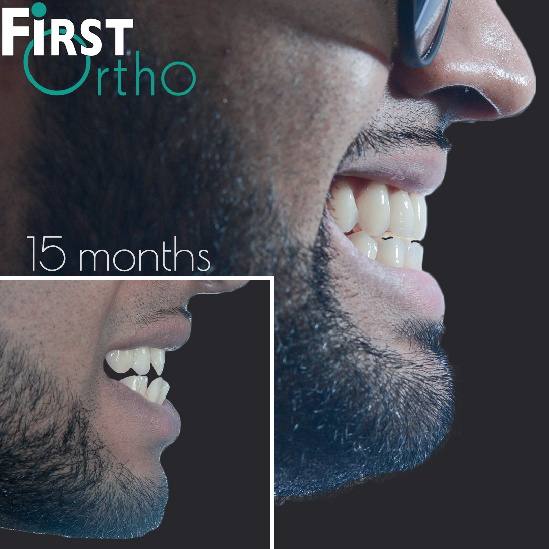 Arch expansion - First Ortho