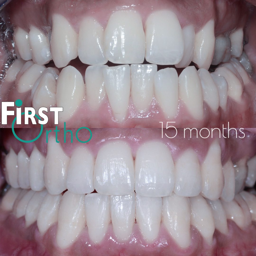 Arch expansion - First Ortho