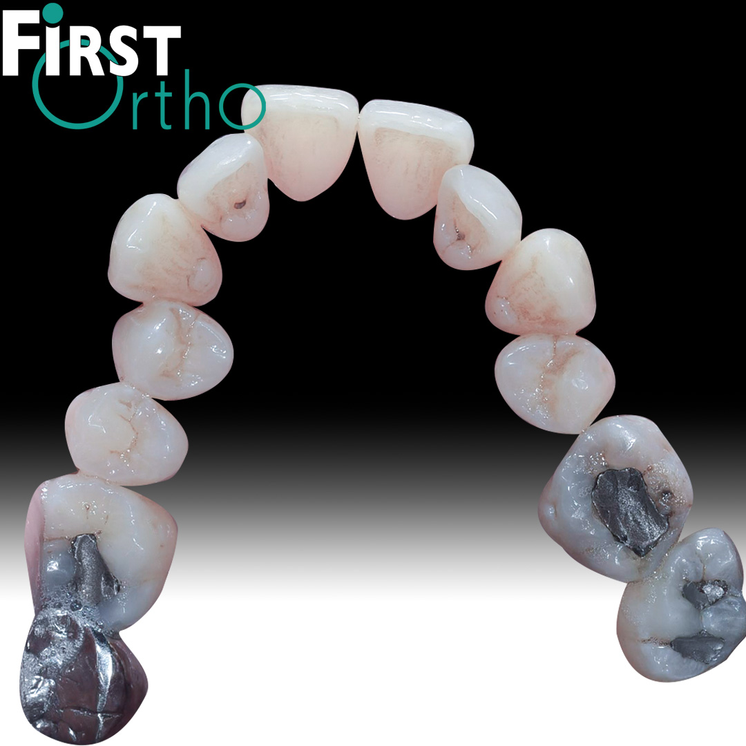 Arch expansion - First Ortho