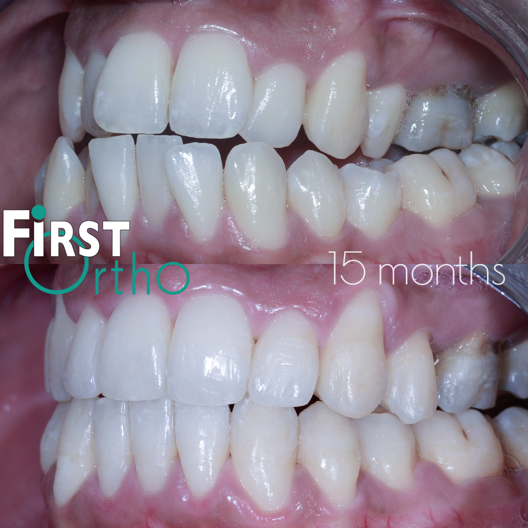 Arch expansion - First Ortho