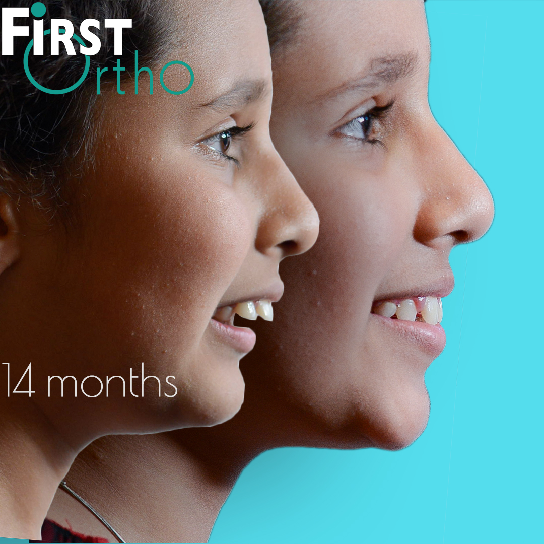 Teeth Sticking out in a Young Girl - First Ortho