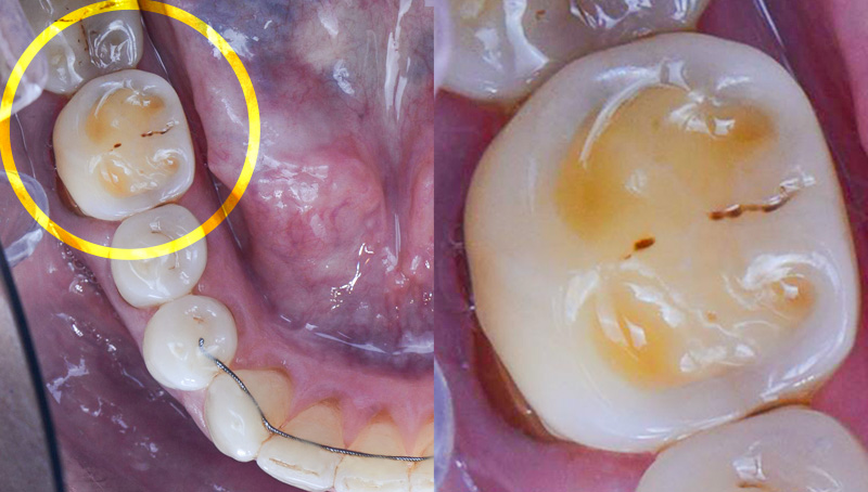 TMJ Disorders - First Ortho