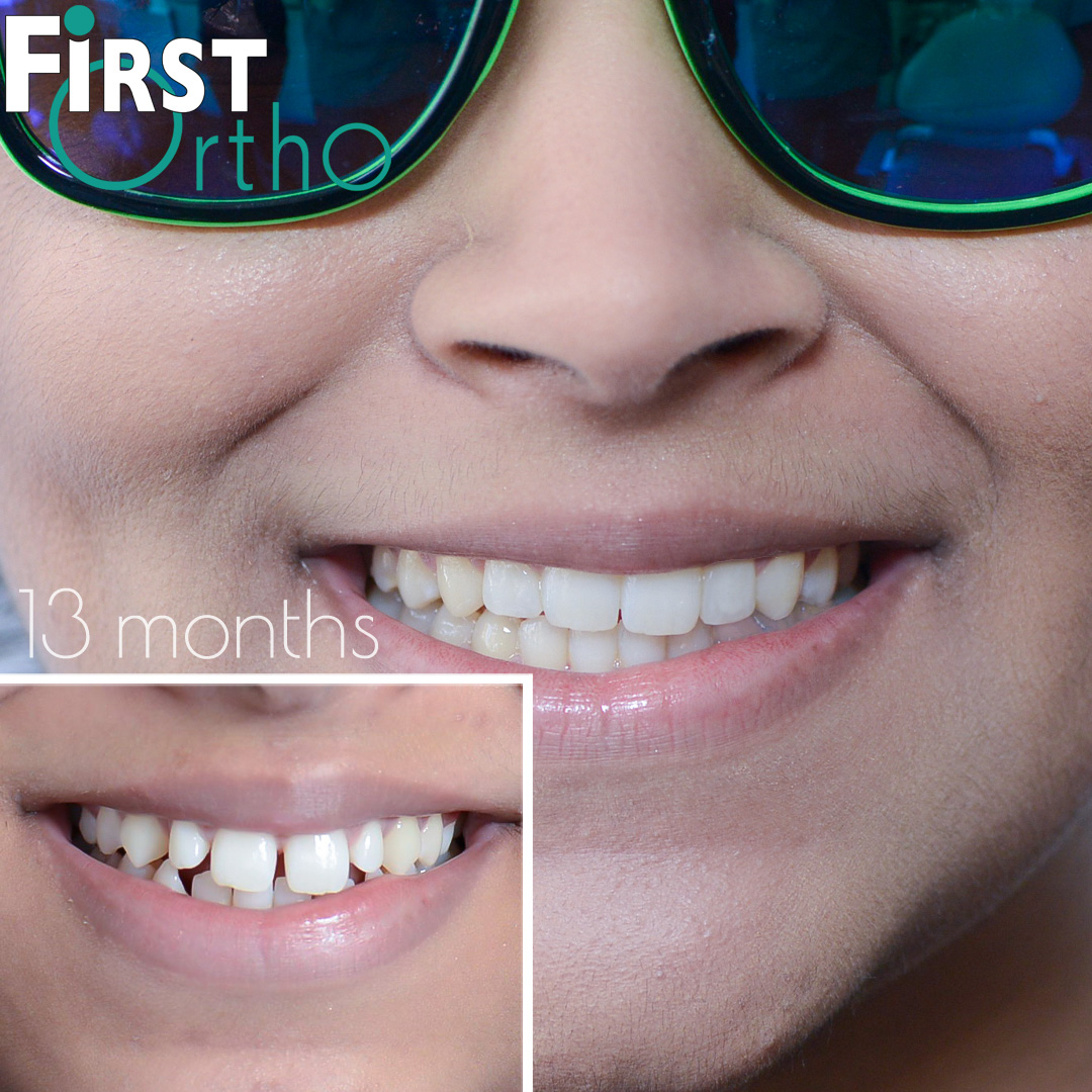 Composite Bonding - First Ortho